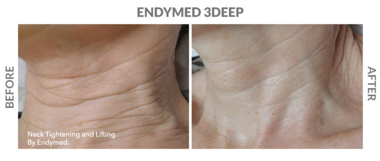 Sculpt Your Body, Tighten Lax Skin and Define Your Jawline with ENDYMED ...